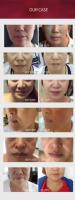 China Sofwave Face Lift Portable Ultrasound Therapy Machine SOFCOOL Anti Aging for sale
