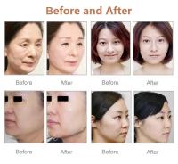 China Painless 3.0mm&4.5mm Radar Carving Vmax face anti-aging beauty device for sale