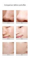 China Korea 13 In 1 Oxygen PDT Skin Rejuvenation Plasma Water Aqua Peeling Hydrodermabrasion Machine With Skin Analysis for sale