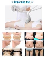 China 2 Handles Portable Vacuum Suction Machine Cryolipolysis Cellulite Remover Machine for sale