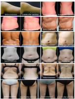 China 30 Minutes Only! Ems Cryo Plates Cryo Slimming Device For Fat Cellulite Removal for sale