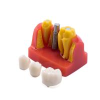 China Class III Instrument Classification Dental Study Model for Dental Practice and Demonstration for sale