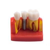 China Class III Instrument Classification Dental Study Model for Dental Practice and Demonstration for sale