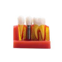 China Class III Instrument Classification Dental Study Model for Dental Practice and Demonstration for sale