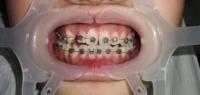 China Multi Function Cheek Retractor Clear Large Medium Small For Dental Orthodontic Procedures for sale