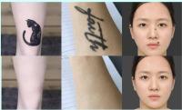China Picosecond YAG Laser Machine for sale
