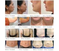 China Portable Rf Fat Burning Machine Trushape Trusculpt ID Radio Frequency for sale