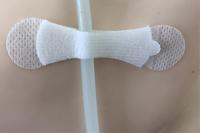 China Medical Disposable Catheter Fixation Device Pressure Sensitive Adhesive for sale