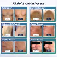 China Salon Nd Yag Alexandrite Laser Hair Removal Machine Vascular Removal 755nm for sale
