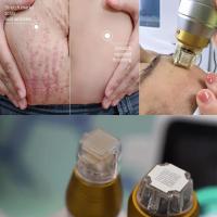 China Skin Lifting RF Microneedling Machine Ance Stretch Marks Removal Machine for sale