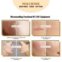 China RF Microneedling Laser Machine Face Lift Acne Scar Treatment Machine for sale