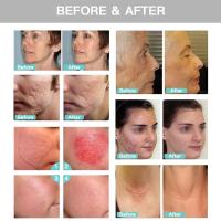 China Face Lifting RF Microneedling Machine Wrinkle Acne Scar Removal Machine for sale