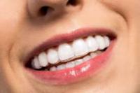 China PETG Thermoform Plastic Sheet 0.5mm PETG Clear Plastic Sheet For Invisalign Teeth Aligners for sale