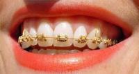 China 0.022/0.018 Slot Size DTC Orthodontic Dental Golden Coated Brackets Brace Ortho Fabric for sale