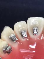 China Clinic Molar Tubes Dental Lingual Brackets for DTC Orthodontics Self-Ligating Bracket for sale