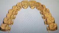 China Powerful Machinery Source DTC Orthodontics Lingual Braces with Self-Ligating Brackets for sale