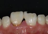 China Translucent Polished Dental Veneer With Minimal Preparation Direct / Indirect Bonding for sale