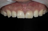 China Translucent Polished Dental Veneer With Minimal Preparation Direct / Indirect Bonding for sale