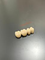China Precision Porcelain Metal Crown PFM Crown For Durable Dental Restorations for sale