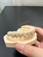 China Precision Porcelain Metal Crown PFM Crown For Durable Dental Restorations for sale