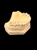 China Biocompatible Tissue Friendly E.MAX Dental Inlay Onlay Fracture Resistance for sale