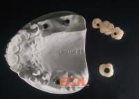 China Adaptable Bone Density TypeⅡ-Ⅳ Bone Dental Implant Bar Component For Dental Restoration for sale