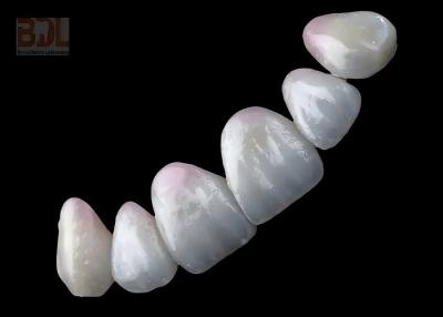 China High Translucency Custom Ceramic Veneer With Longevity 10 Plus Years In Dental for sale