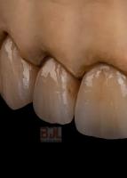 China High Fracture Toughness Ceramic Dentures with High Translucency and Low Thermal Conductivity for Dental Restorations for sale