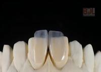 China Porcelain Emax Veneers With Cast Porcelain Ultra Thin Handmade Porcelain Stacking for sale