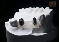 China Zirconia Dental Implant Restores Tooth Function And Prevents Bone Absorption for sale