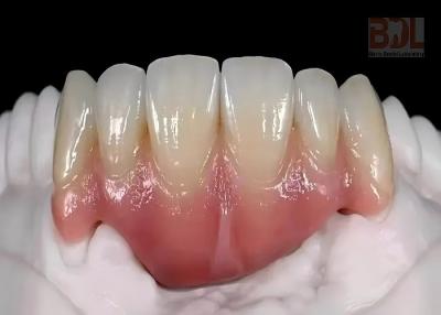 China Zirconia Dental Implant Restores Tooth Function And Prevents Bone Absorption for sale