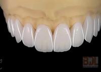 China Emax Veneer Dental Restorations with 400 MPa Flexural Strength Metal-free Biocompatibility for Anterior Posterior Crown Bridge for sale