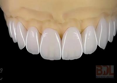 China Emax Veneer Dental Restorations with 400 MPa Flexural Strength Metal-free Biocompatibility for Anterior Posterior Crown Bridge for sale