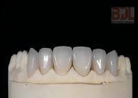 China Emax Veneer Dental Restorations with 400 MPa Flexural Strength Metal-free Biocompatibility for Anterior Posterior Crown Bridge for sale