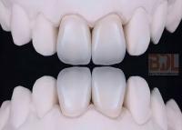 China Sintering Temperature 850C-950C Emax Veneer with Flexural Strength ≥400 MPa and Metal-free Composition for Dental Restoration for sale