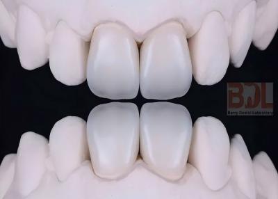 China Sintering Temperature 850C-950C Emax Veneer with Flexural Strength ≥400 MPa and Metal-free Composition for Dental Restoration for sale