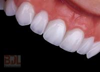 China Flexural Strength 400MPa IPS Emax Veneer with 16 Shade Dentin Enamel Scale and High Translucency for sale