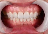 China Flexural Strength 400MPa IPS Emax Veneer with 16 Shade Dentin Enamel Scale and High Translucency for sale