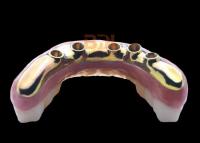 China 3.2mm Implant Bar Malong Bridge Dental Implant Solutions 11mm 16mm 21mm Precision for sale