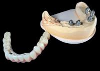 China 3.2mm Implant Bar Malong Bridge Dental Implant Solutions 11mm 16mm 21mm Precision for sale