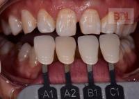 China Wear Resistance Porcelain Fused To Metal With Good Biocompatibility Natural Tooth Appearance for sale