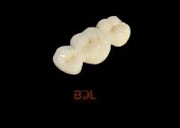 China Good Biocompatibility Porcelain Infused Metal Crown Wear Resistance Natural Tooth Appearance for sale