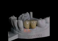 China Custom Color Matching PFM Porcelain Dental Prosthetics With Strong Metal Ceramic Bond for sale
