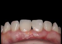 China Tooth Shade Matched Porcelain Fused To Metal Crown Featuring COCr Metal Construction for sale