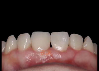 China Tooth Shade Matched Porcelain Fused To Metal Crown Featuring COCr Metal Construction for sale