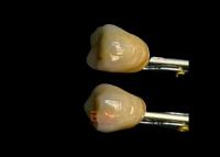 China Strong Metal Ceramic Bond Porcelain Fused To Metal Dental Restoration Good Biocompatibility for sale
