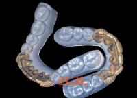 China Natural Tooth Appearance PFM Crown Dental Ceramic For Optimal Fit Exceptional Durability for sale