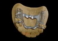China Comfortable Fit Metal Partial Dentures Incorporating High Biocompatibility Metal Framework for sale