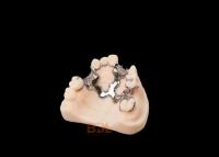 China High Biocompatibility Cobalt Chromium Metal Partial Dentures For Dental Restoration for sale
