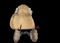 China Wear Resistant Dental Precision Attachments With High Retention Force Corrosion Resistant for sale